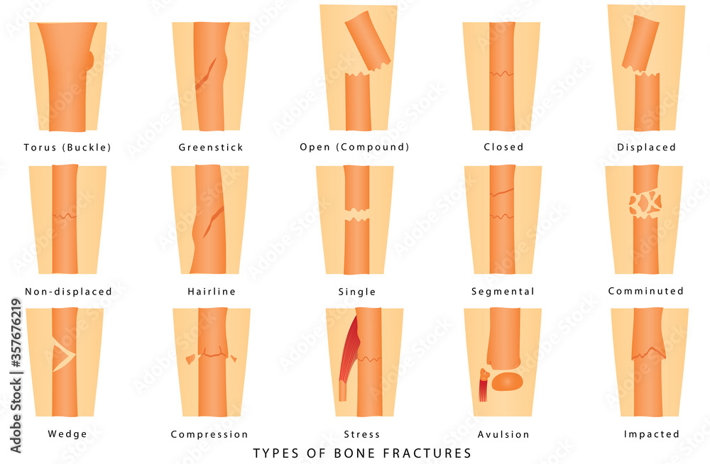Types of fracture. Human Broken Bone. Different types of bone fractures ...