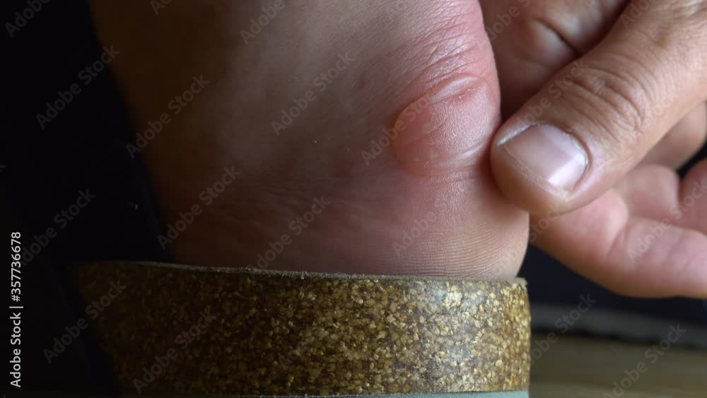 Terrible bladder on the heel. Hand touching painful blister skin on the ...