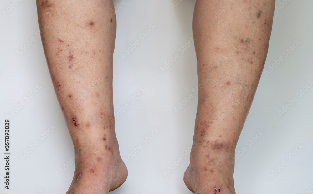 Scars from inflammation, infection on the skin of the legs. Stock Photo ...