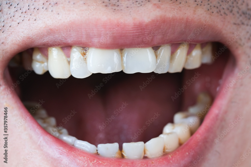 Tooth's a man smoking bad. Man smokes a cigarettes have tooth decay and ...