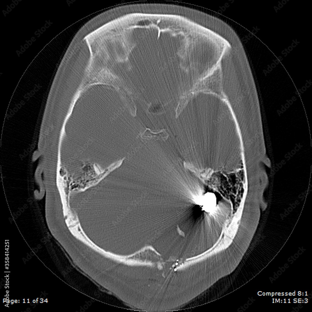 CT scan axial view bullet fragmentation in brain male 20 year old Stock ...