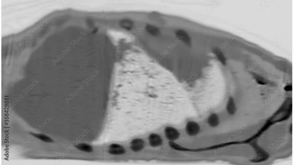 CT chest lung sagittal view with contrast Male 77year old abscess lung ...