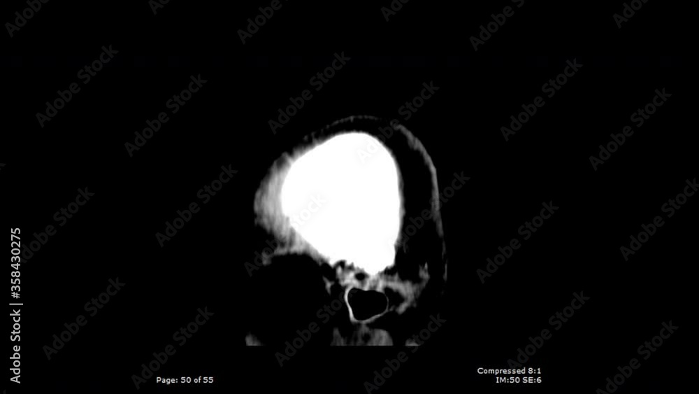 CT scan sagittal view with bullet fragmentation in brain male 20 year ...