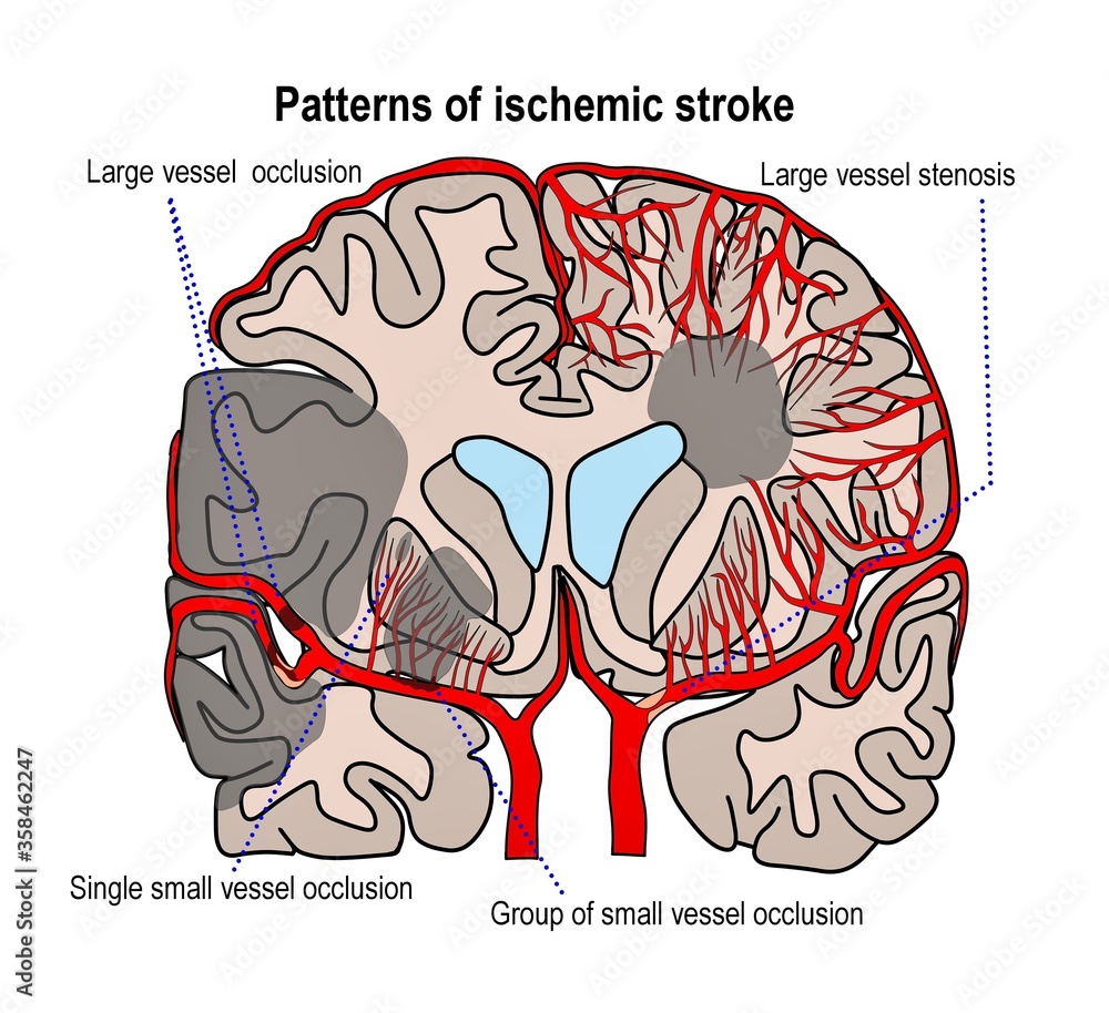 The different location of blocked arteries causing the different site ...