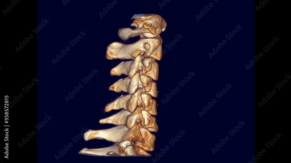 CT C-spine or Cervical Spine 3d rendering image of patient trauma case ...