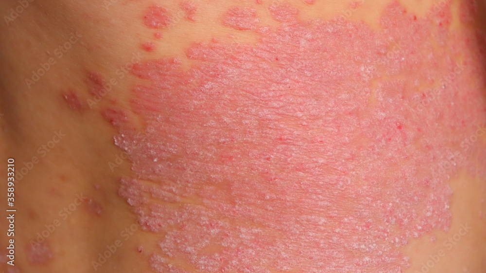psoriasis, chronic non-infectious skin disease, autoimmune disease, red ...