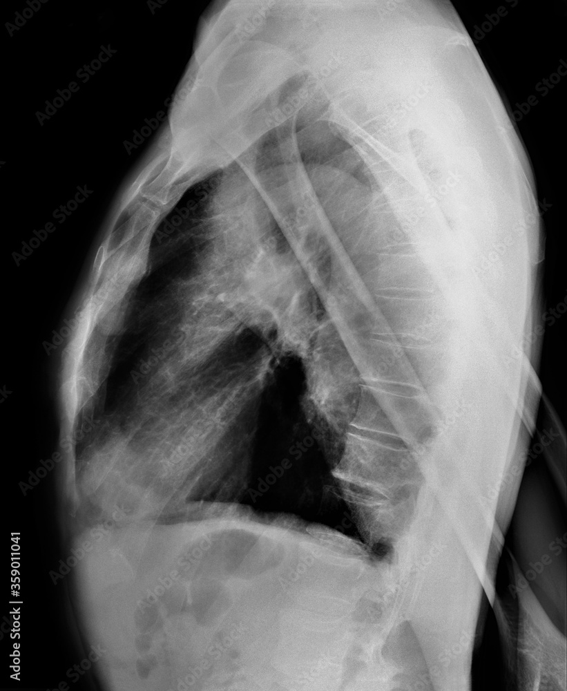 x-ray of the human chest in a lateral projection Stock Photo | Adobe Stock