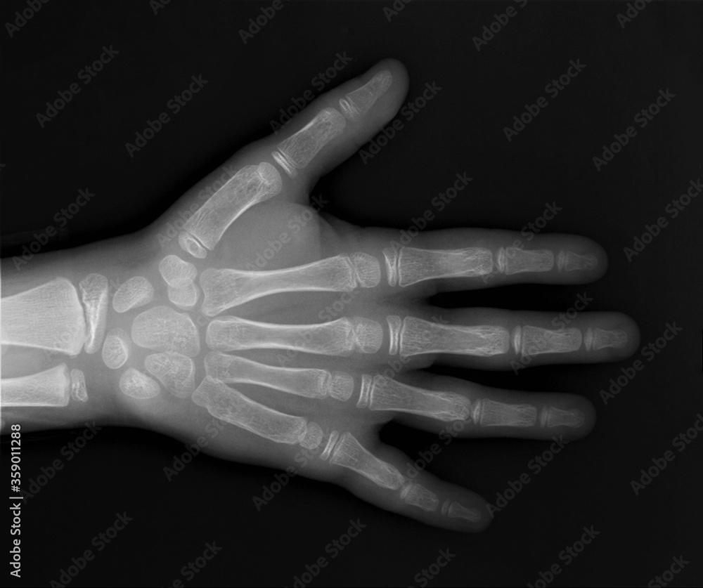 radiography of the hand bones without pathology Stock Photo | Adobe Stock