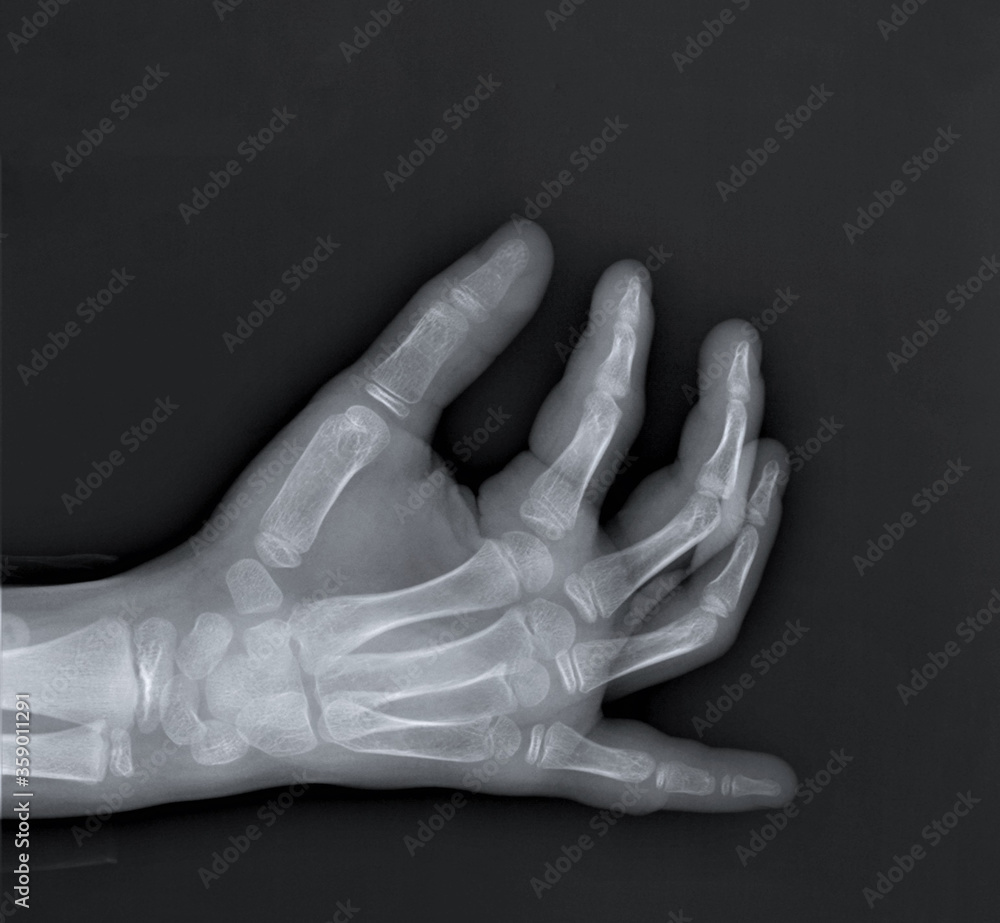 Foto de radiography of the hand bones without pathology do Stock ...