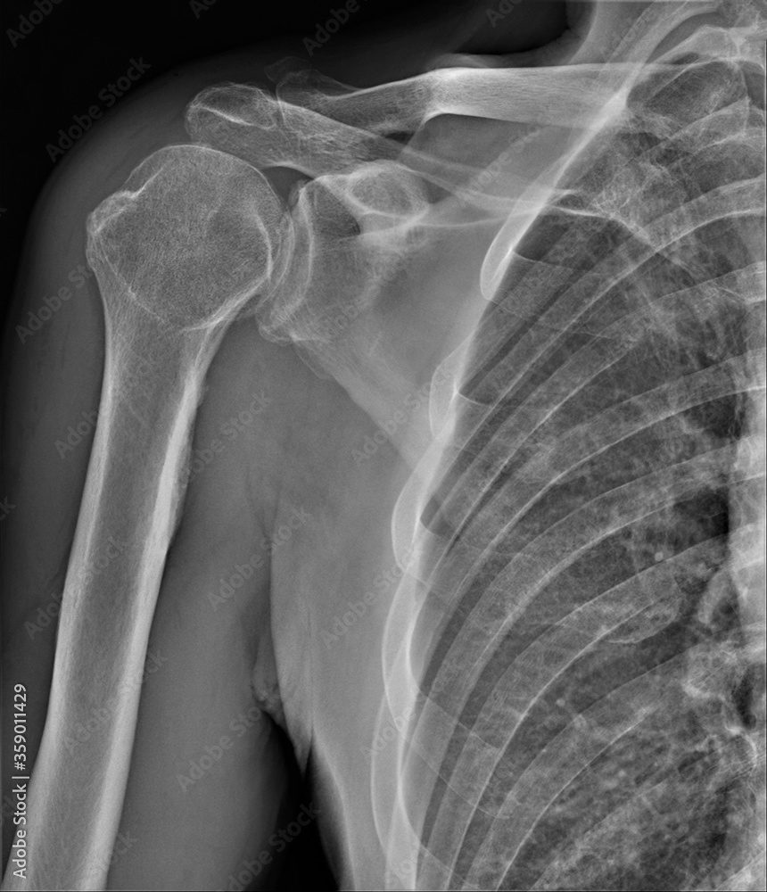 x-ray of the shoulder joint of an adult in a direct projection Stock ...