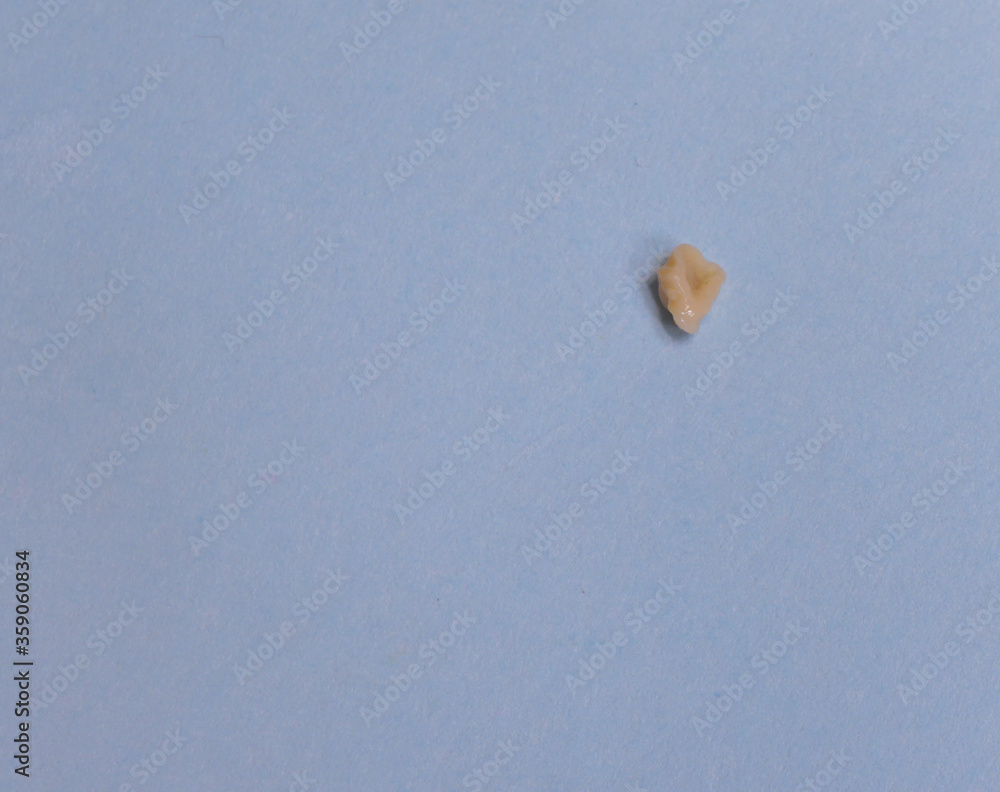 Tonsil stone (tonsillolith) on a piece of paper Stock Photo | Adobe Stock