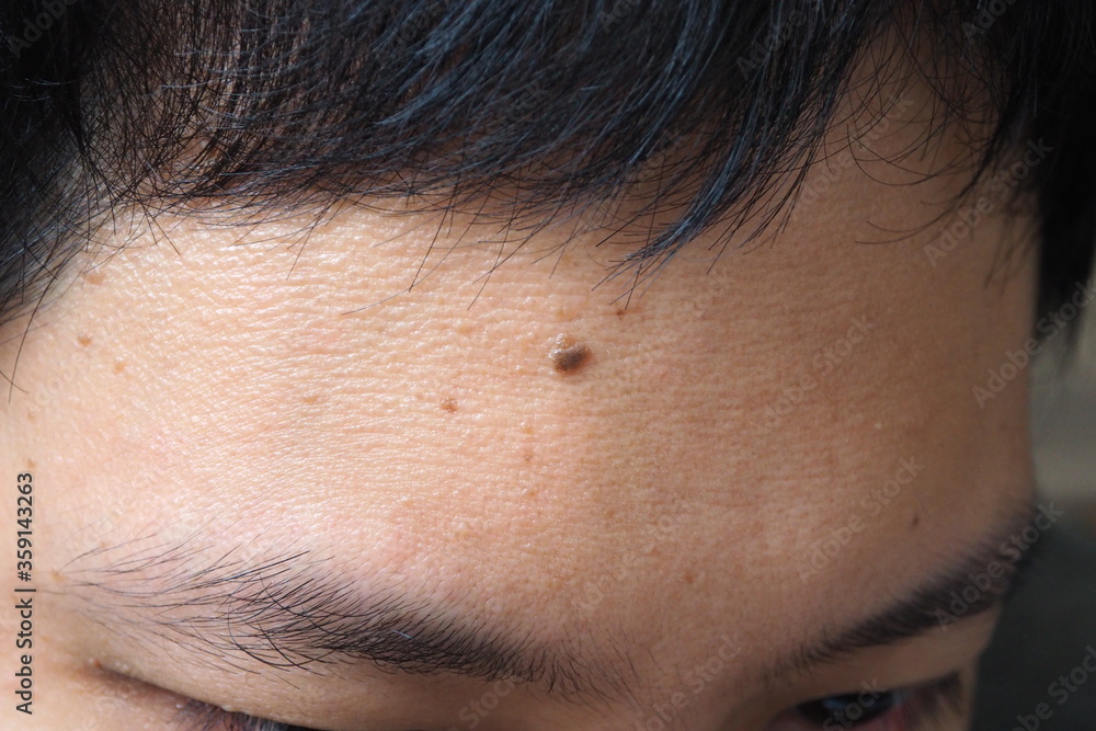 Black moles and skin texture with acne on Asian male forehead for ...