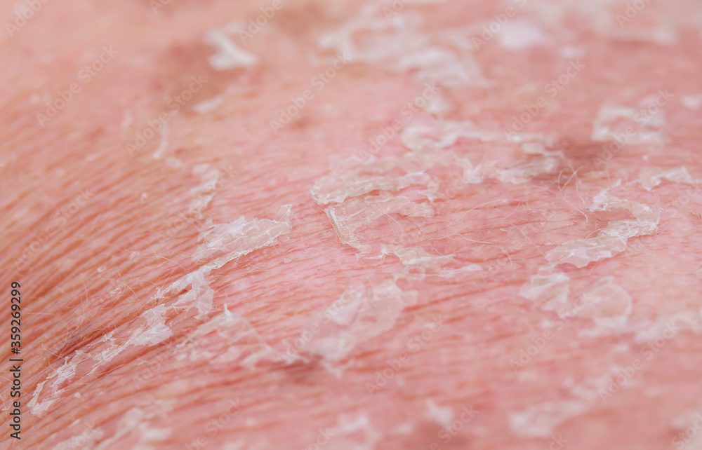 textured background with scales of dead skin cells with cracks and ...