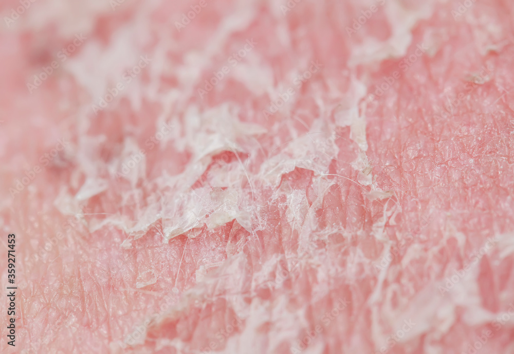 texture of irritated unhealthy skin with scales of dead cells and ...
