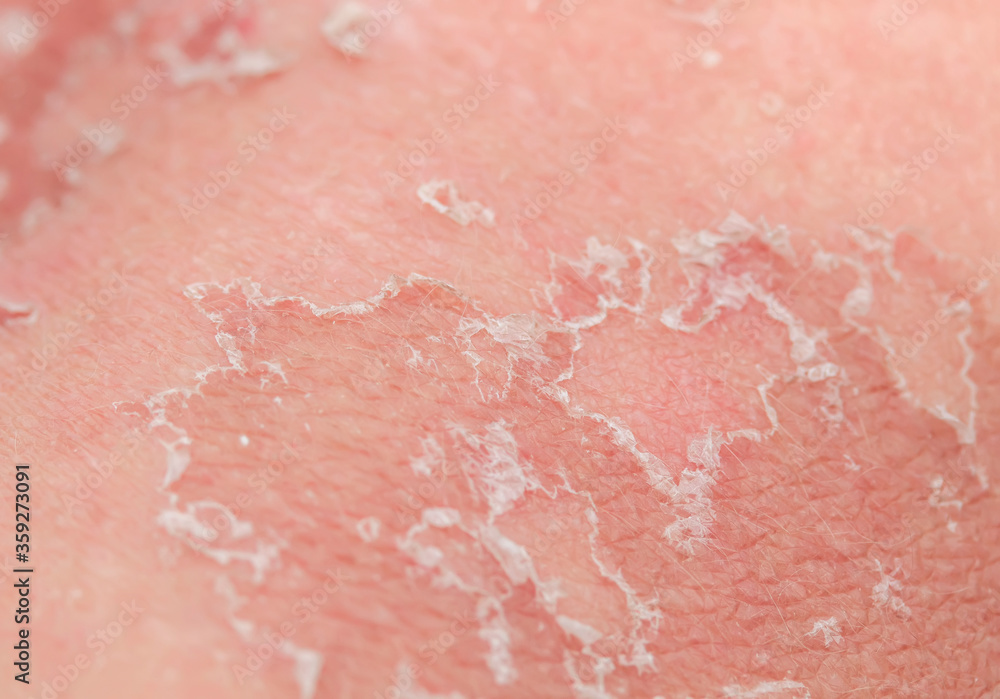 background with texture of irritated skin with cracks of dead cells and ...