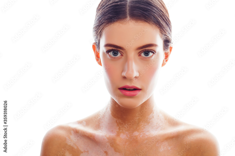 beautiful young brunette woman with vitiligo disease isolated on white ...