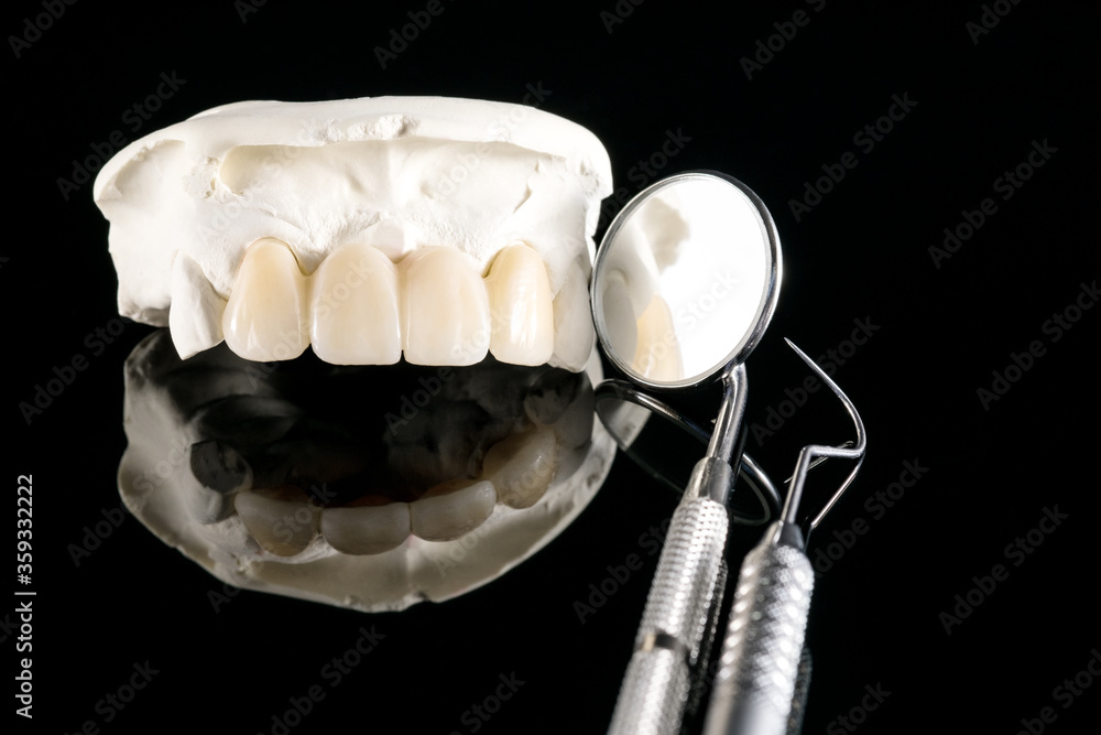 Closeup / Prosthodontics or Prosthetic / Tooth crown and bridge implant ...