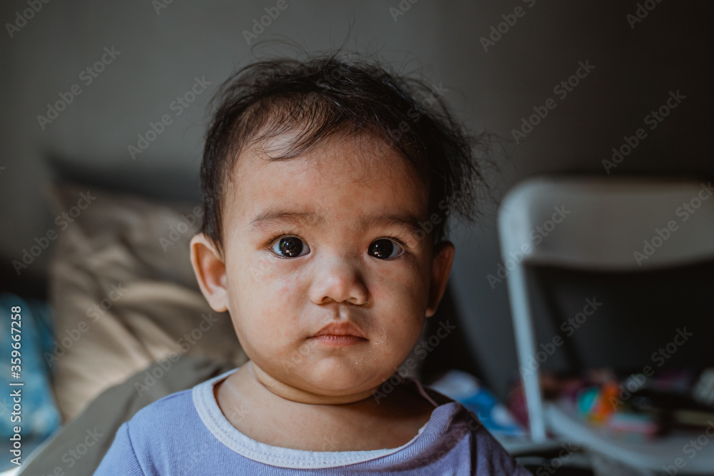 portrait of asian baby with skin rashes from allergies or irritation ...
