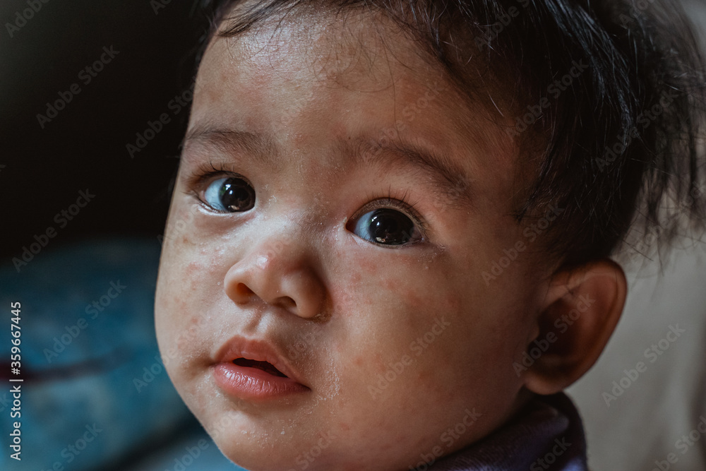 portrait of asian baby with skin rashes from allergies or irritation ...