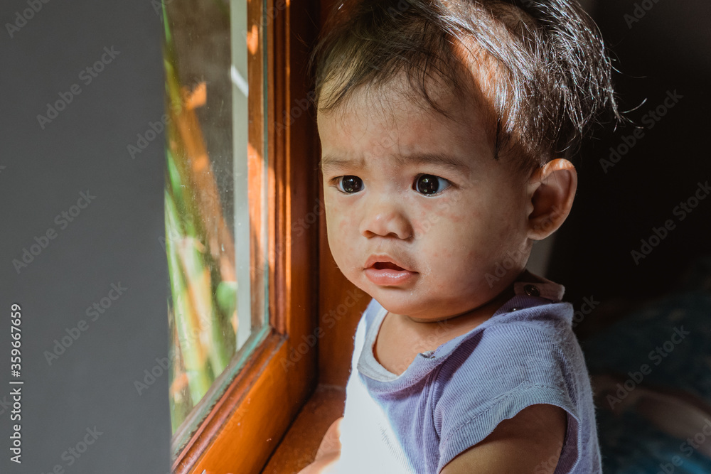 portrait of asian baby with skin rashes from allergies or irritation ...