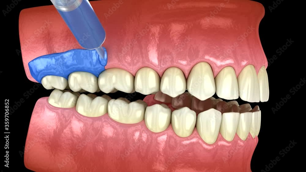 Proffesioinal teeth whitening, light-activation on tooth bleaching. 3D ...