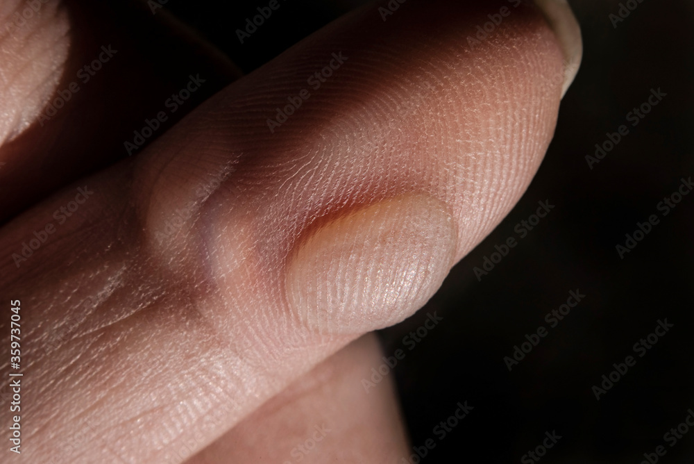 Foto Stock Big corn close up on index finger in woman. The woman worked ...