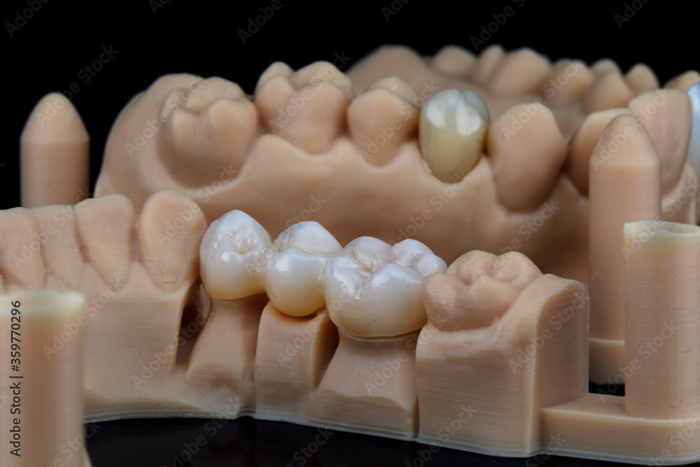 dental crowns of different cavities on a model made on a 3D printer ...