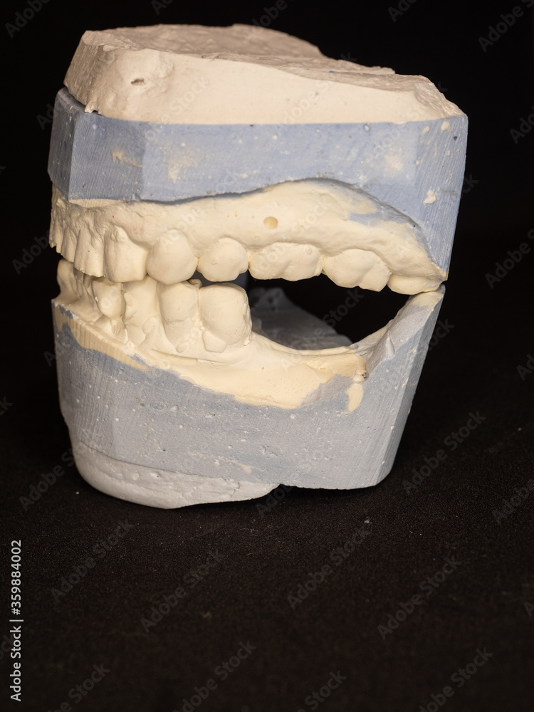 Human jaws defect. Crooked teeth and rotate bite. Stock-Foto | Adobe Stock