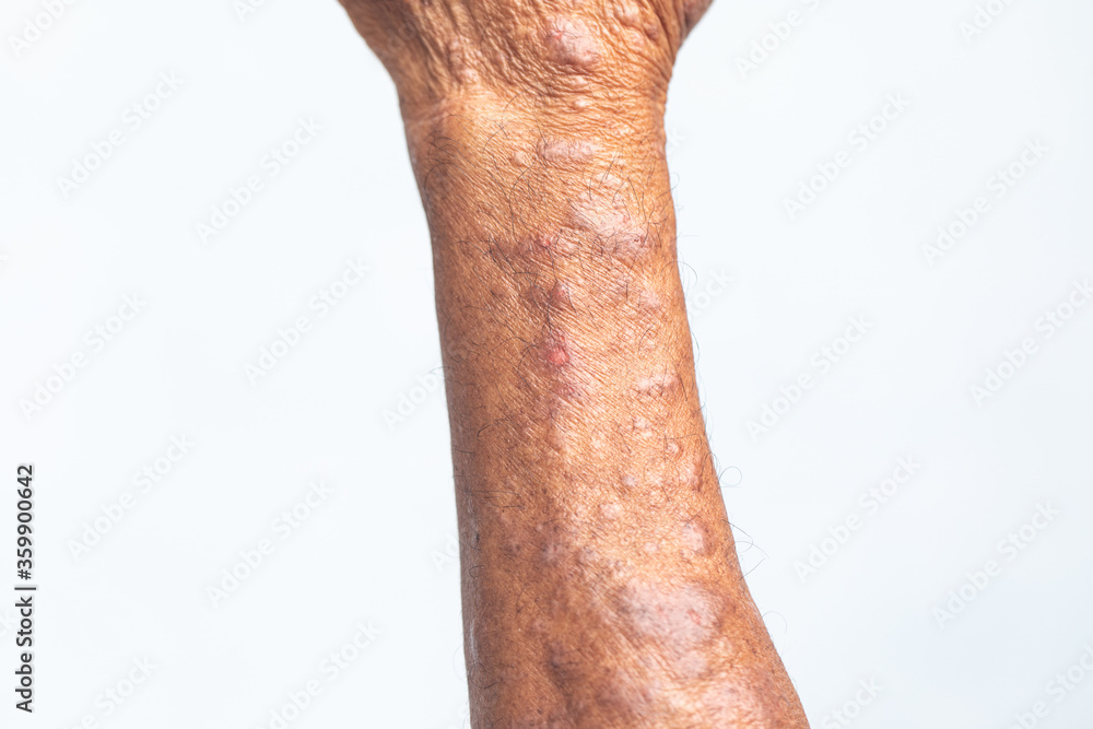 A physical of Atopic dermatitis (AD), also known as atopic eczema, is a ...