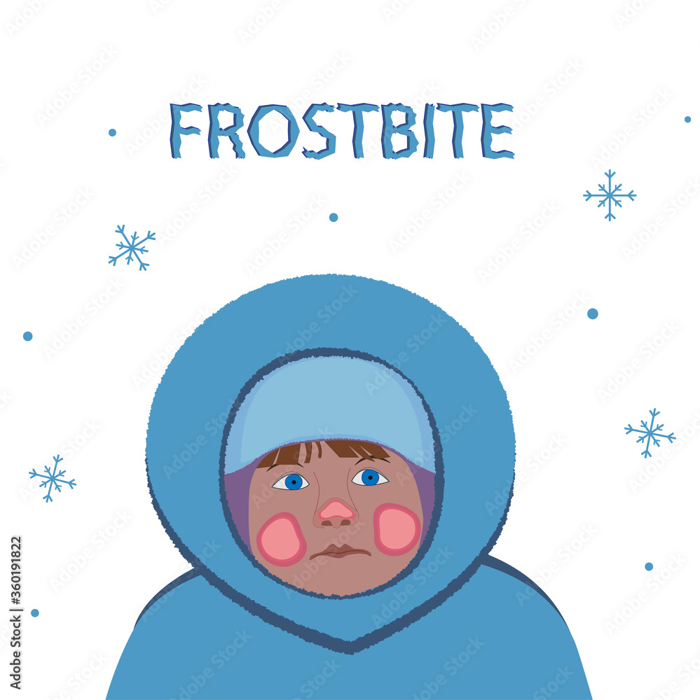 Vector illustration on a white background the child received frostbite ...