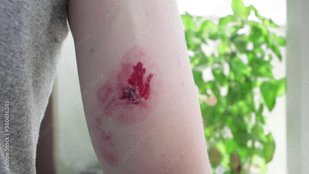 An open wound on the man's arm. The skin peeled off. A donkey bite, a ...