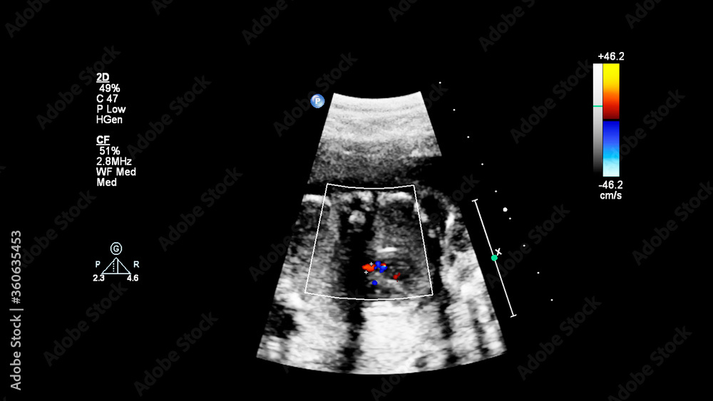 Ultrasound screen with fetal echocardiography Stock Photo | Adobe Stock
