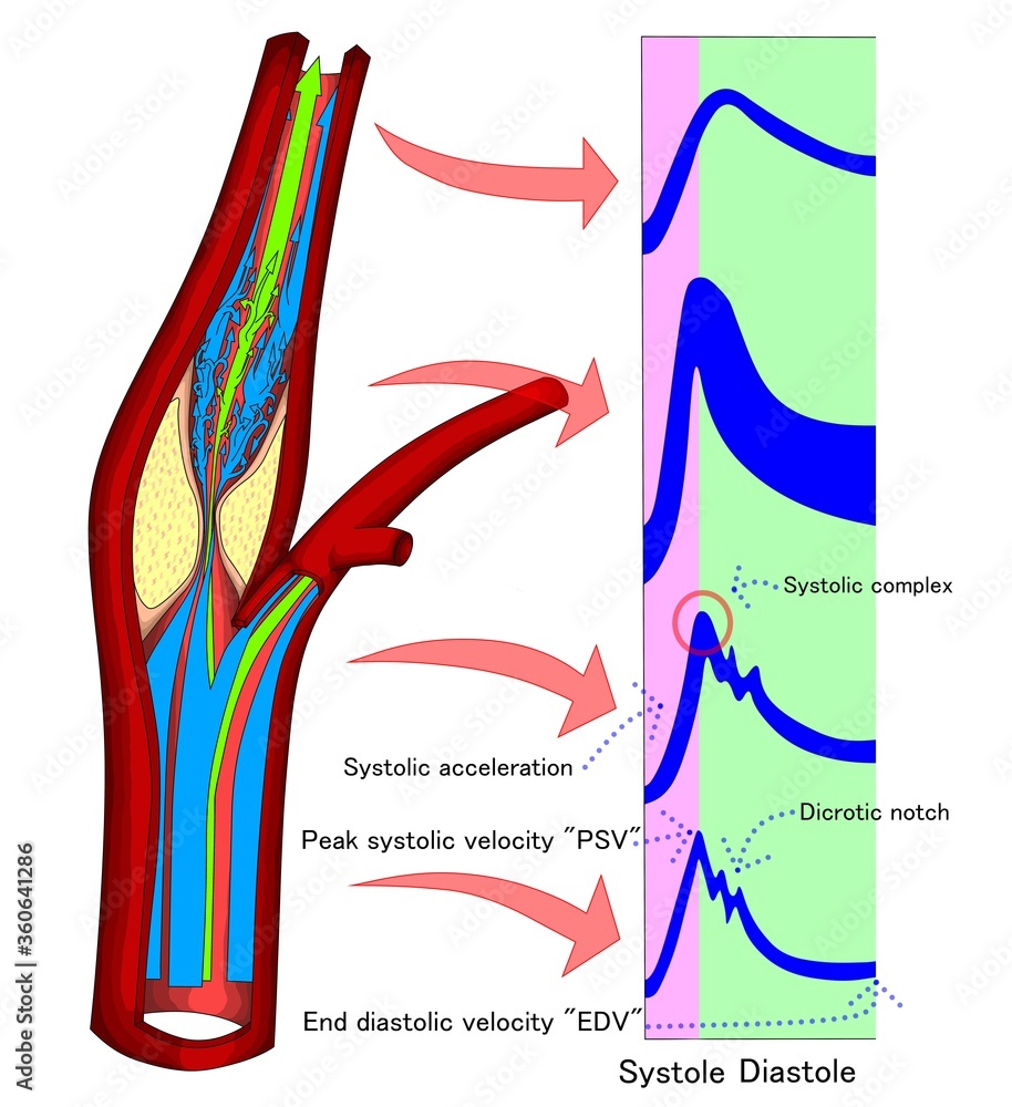 The physiology of dynamic flow of blood in carotid artery stenosis ...