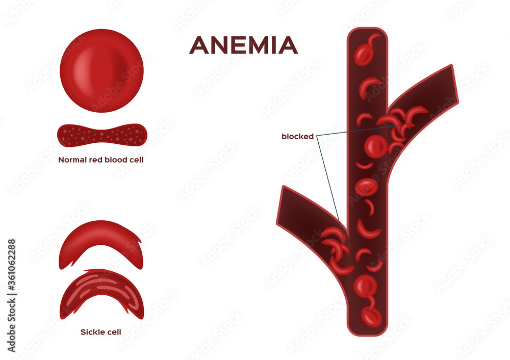 Poster Normal red blood cell and sickle cell vector / anemia on white ...