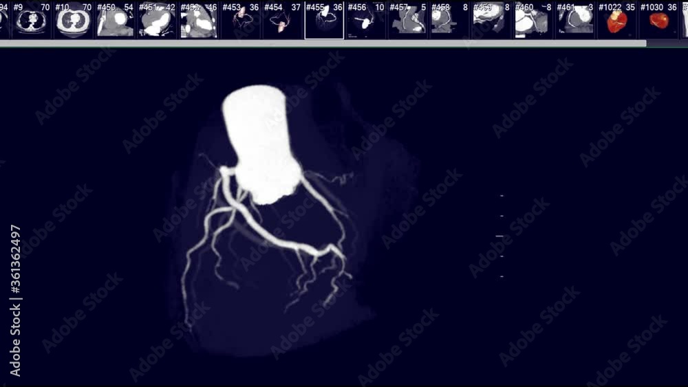 CTA Coronary artery 3D rendering image or coronary tree mip mip ...