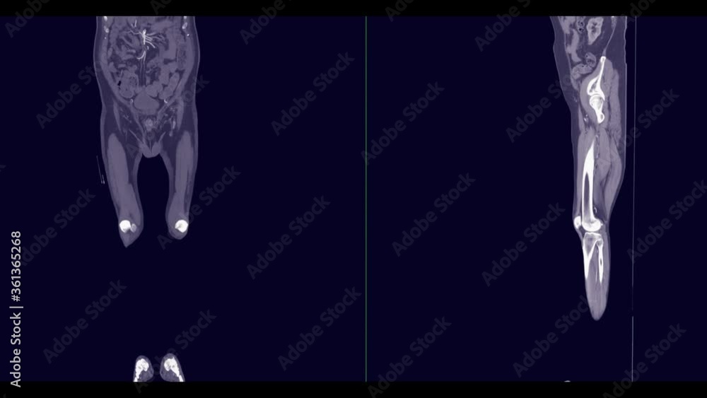 CTA femoral artery run off Coronal mip and sagittal mip view. Stock ...