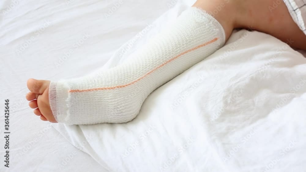 Children's leg in cast on a white bed in the orthopedic department ...