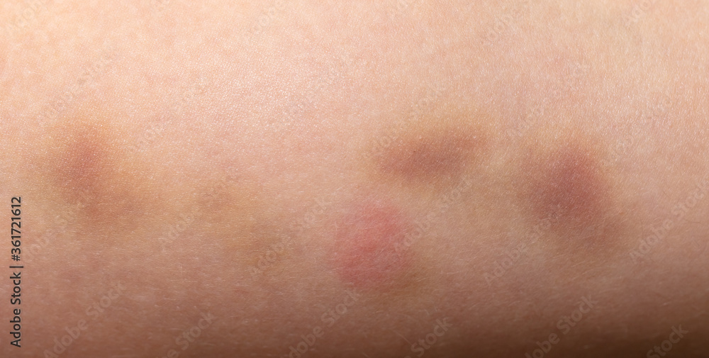 Closeup bruise on human skin as a background. Stock Photo | Adobe Stock