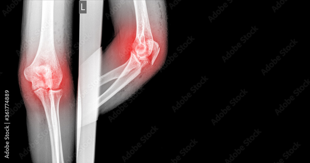 X-ray elbow showing fracture (proximal Ulna or Olecranon fracture ...