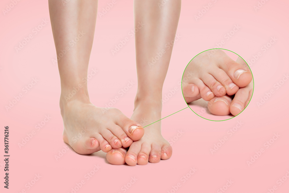 Female feet placed one on top of the other, with nail fungus disease ...