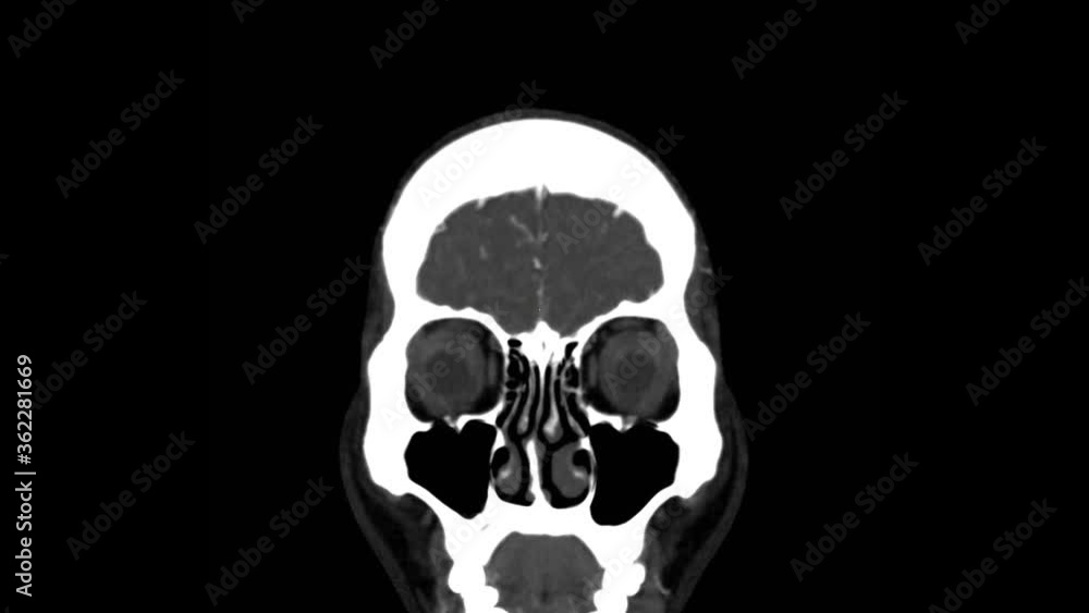 Computed Tomography Angiography of Brain in coronal view. Stock ビデオ ...