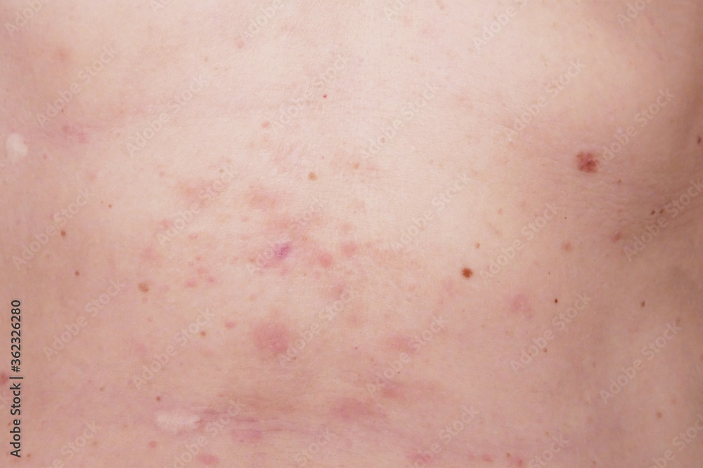 skin rash treatment on woman body. Shingles, Disease, Herpes zoster ...