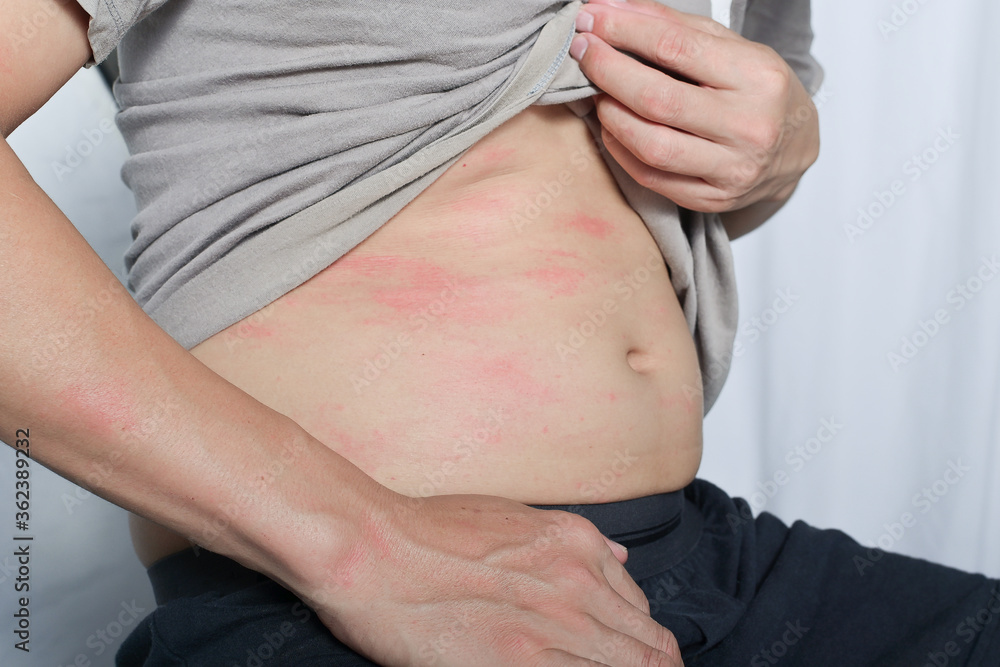 Allergy is a red rash on the body is Rash caused by a Caterpillar foto ...