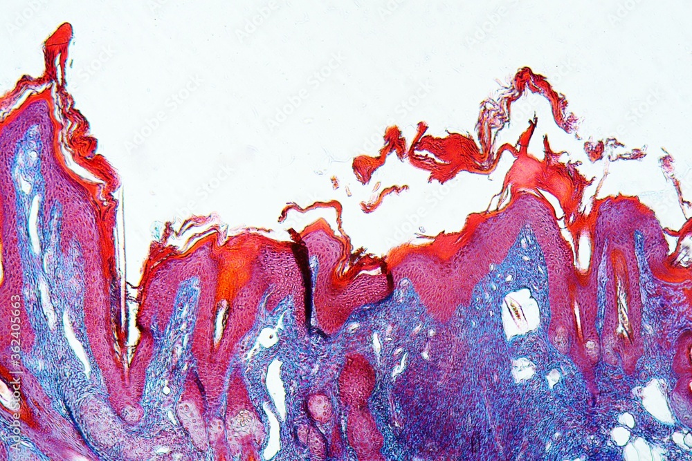 Human skin with a Scabies infection, Sarcoptes scabiei, under the ...