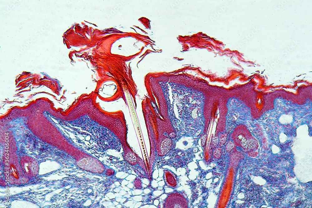 Human skin with a Scabies infection, Sarcoptes scabiei, under the ...