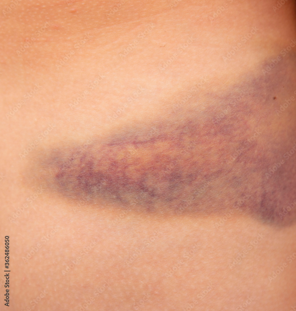 large bruise on the skin on the leg Stock Photo | Adobe Stock