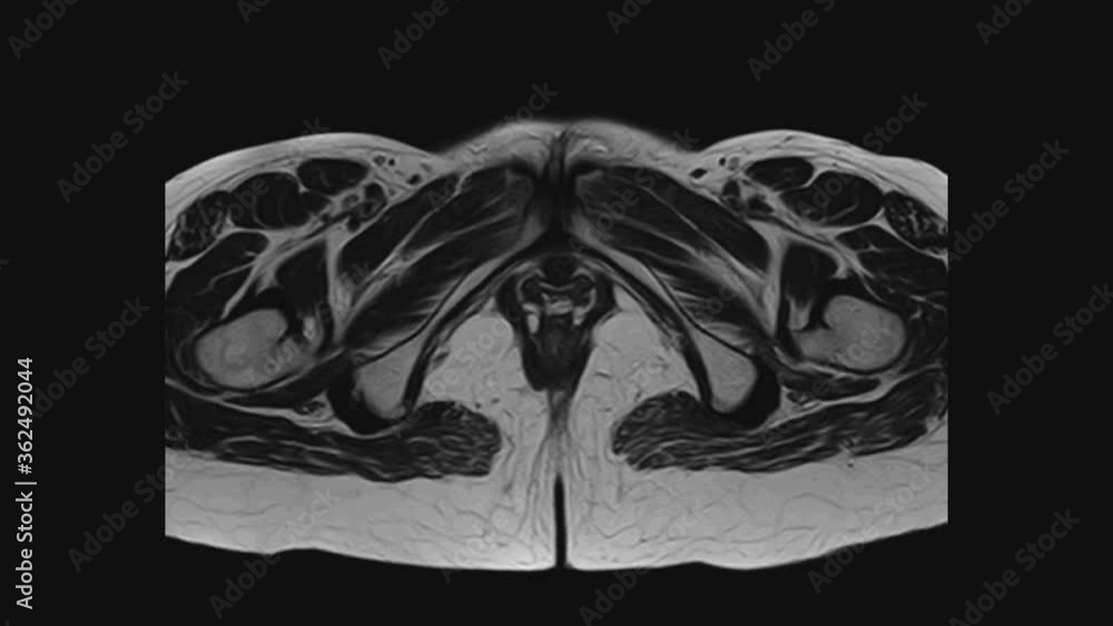 MRI of the female pelvic organs, abdominal cavity, gastrointestinal ...