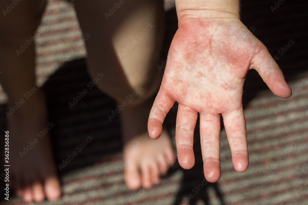 Red rash on the hands of the palms of the child, rubella scarlet fever ...