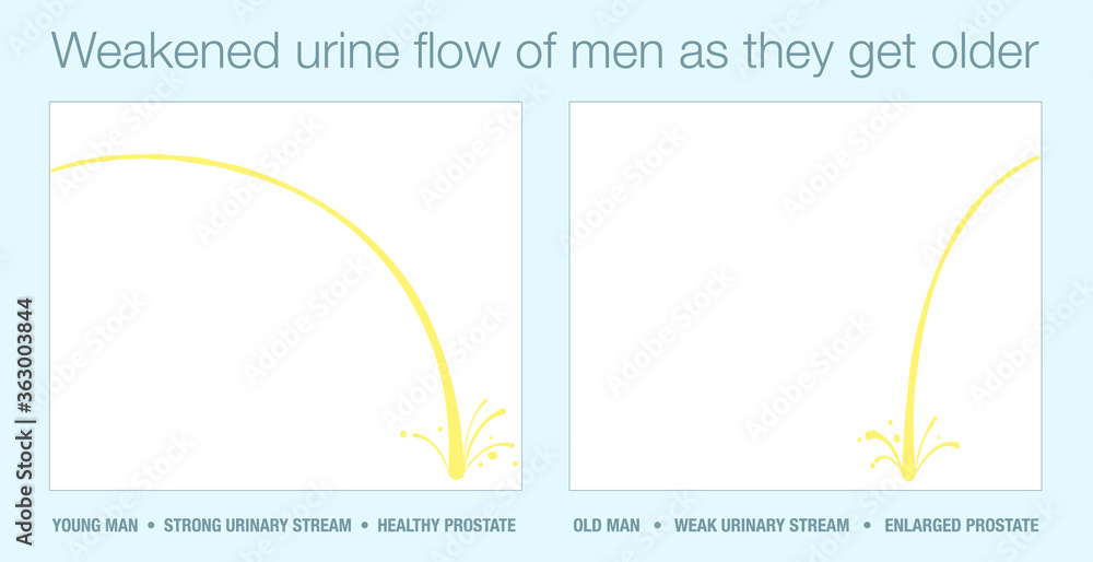 Strong urine stream of young man with healthy prostate and stream of ...