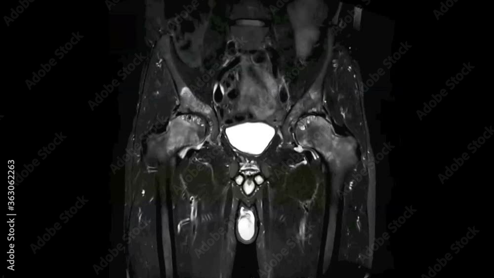 Osteonecrosis Of Hip